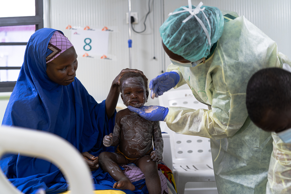 Measles-related admissions reach record at MSF facilities in Maiduguri ...
